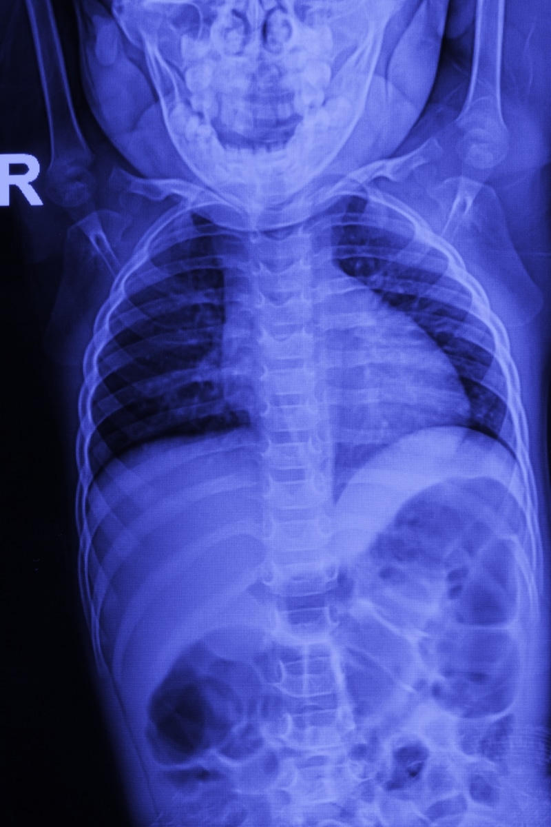 5-Rayos X de tórax - Canal Chupete