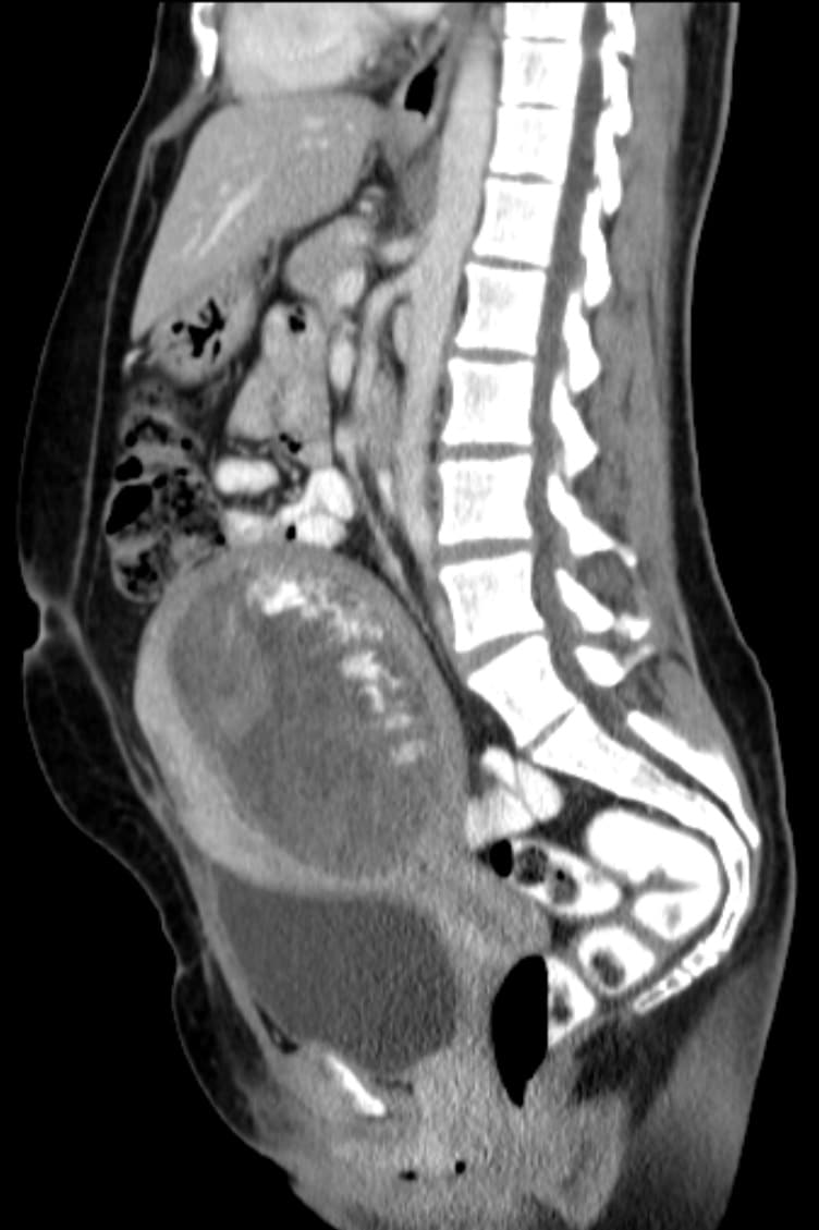 ¿Qué es el embarazo molar? Descubre más sobre esta enfermedad
