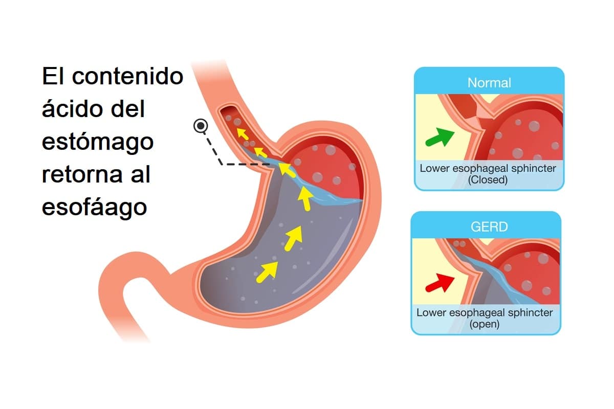 Reflujo gastroesofágico en bebés y niños: ¿qué es y cómo solucionarlo?